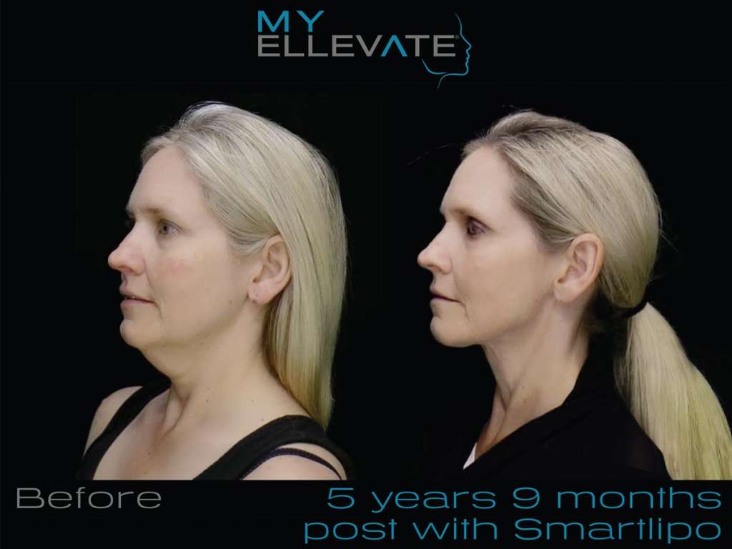 MyEllevate Jaw Line Sculpting Procedure in OKC | Dr. Tim Love