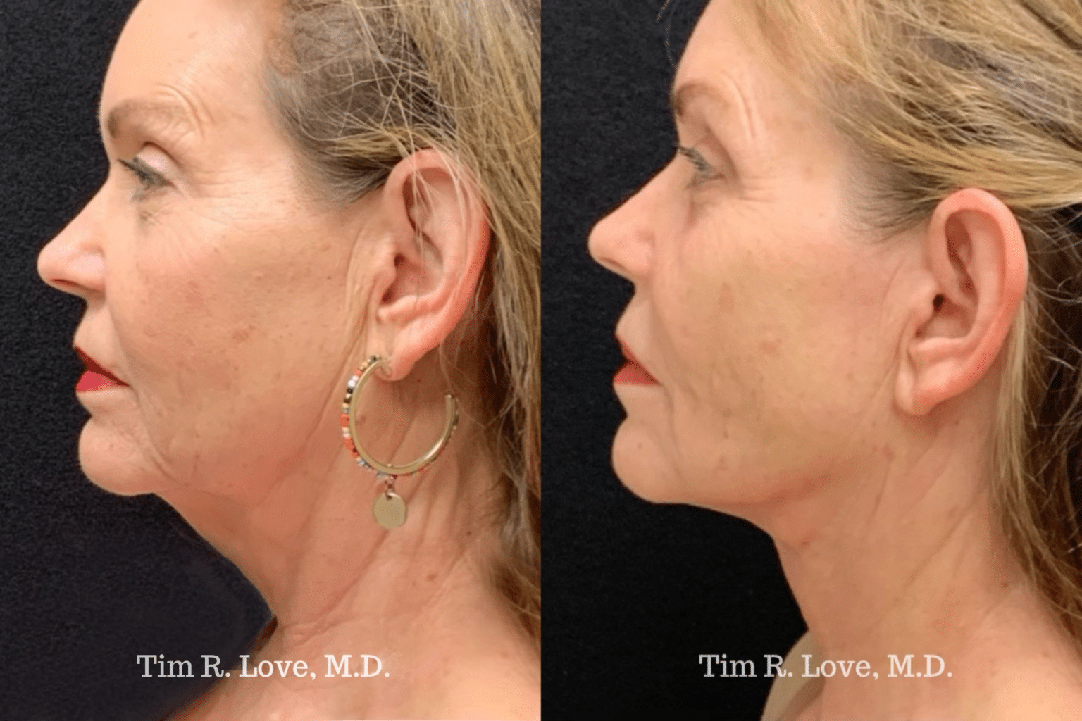 MyEllevate Jaw Line Sculpting Procedure in OKC | Dr. Tim Love